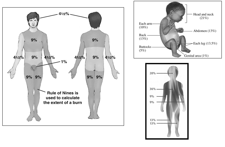 rule-of-9 | First Aid Courses Nelspruit